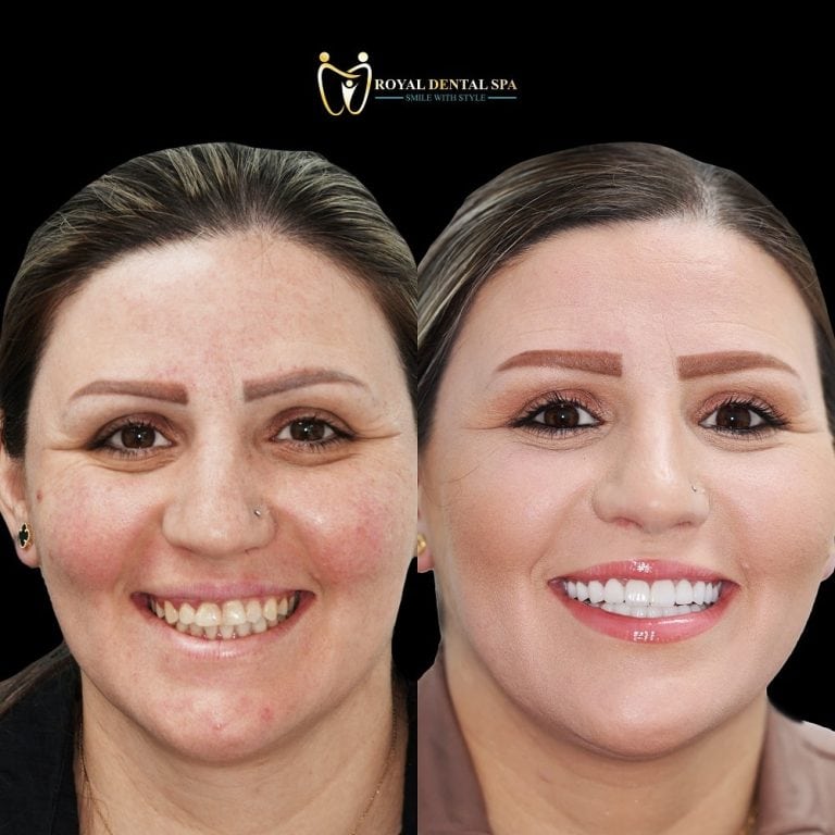 Smile Gallery - Wisdom Tooth Extraction Craigieburn | Safe Wisdom Tooth ...